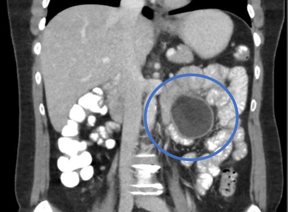 Small Intestine Cancer and Tumors - Maher A. Abbas, MD | Dubai/UAE
