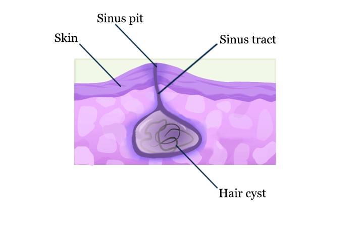 Pilonidal Disease - Maher A. Abbas, MD, proctologist, colorectal surgeon