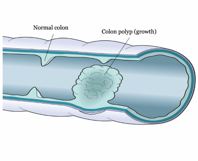 Colorectal Polyps - Maher A. Abbas, MD